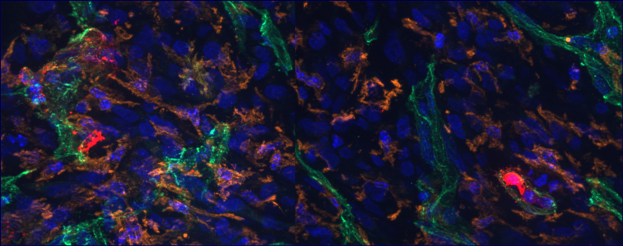 Nanoparticles in brain tumor vessels © Françoise Geffroy, CEA-DRF ...