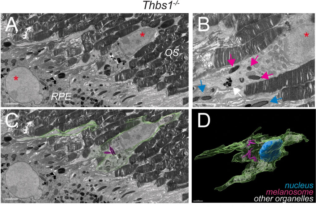 Using SBF-SEM to better understand an eye degeneration disease: the AMD ...